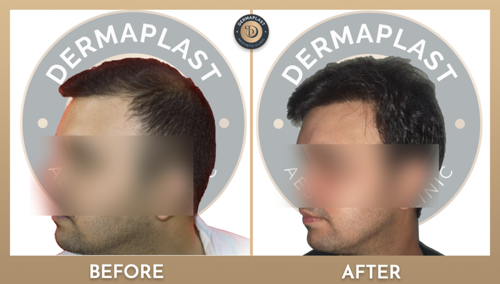 Dermaplast Aesthetic Clinic | Gallery | Treatments Reults